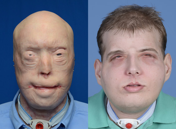 Most extensive full face transplant ever: Hero firefighter who saved ...